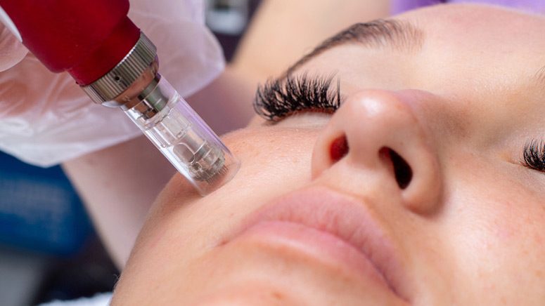 Microneedling Under The Eyes: Procedure, Cost and More – Page 7 ...