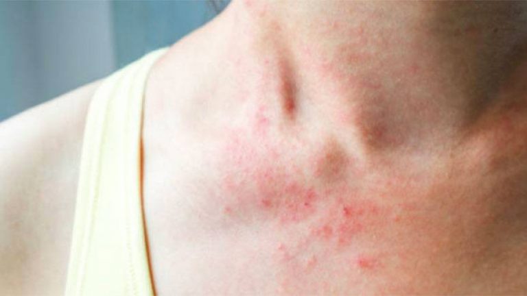 Dupixent Injection: Uses, Side Effects, Dosage & More – Page 2 ...