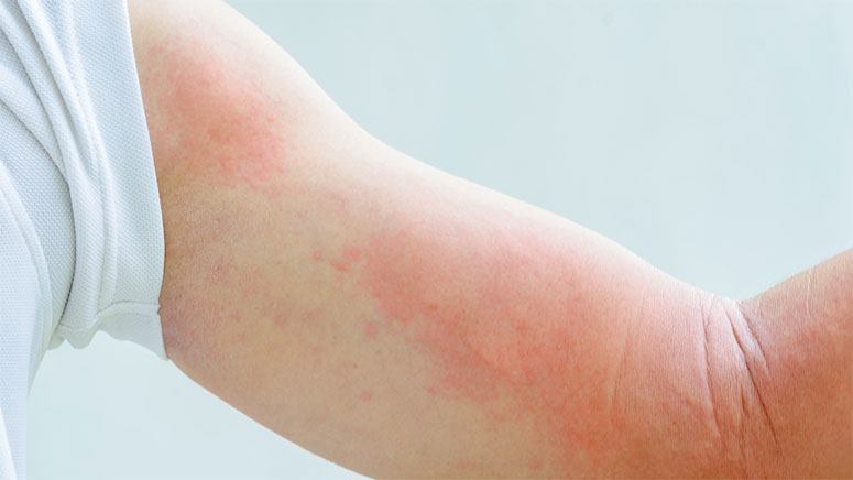 Dupixent Injection: Uses, Side Effects, Dosage & More – Page 6 ...