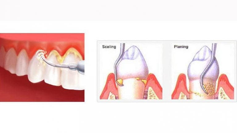 Hole in Gums – Causes, Symptoms, Treatments & More – Page 5 – Entirely ...