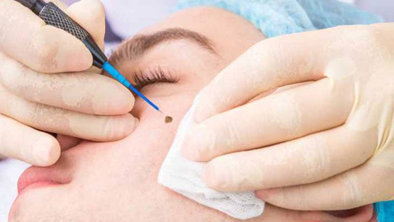 What is Cryosurgery – Purpose, Procedure & Risks? – Page 6 – Entirely ...