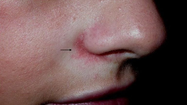 Perioral Dermatitis Treatment, Causes, and Natural Remedies – Entirely ...