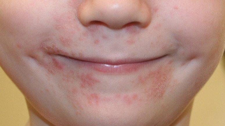 Perioral Dermatitis Face