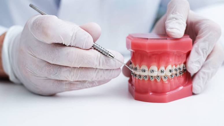 Speed Braces – Effectiveness, Cost, Comparisons, and More – Entirely Health