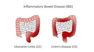 Calprotectin Stool Test: Uses and How It Works – Entirely Health