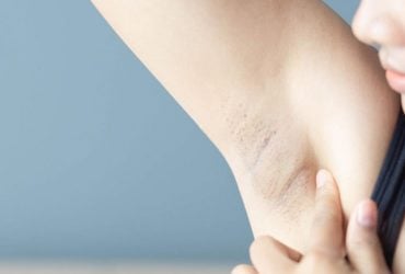 Axillary Lymph Node Dissection – Entirely Health