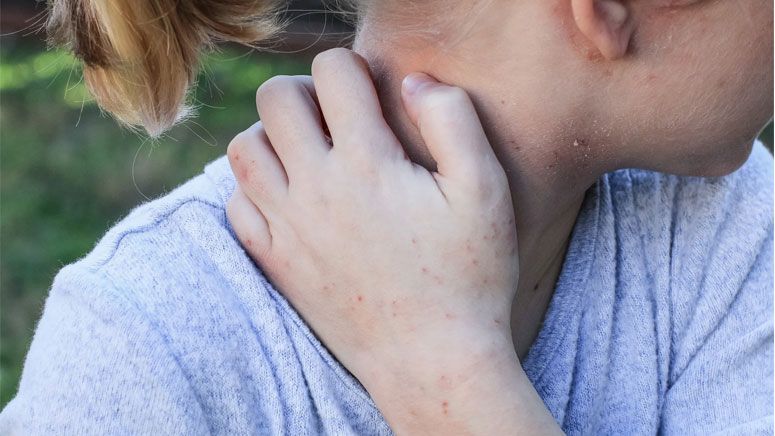 Psoriasis in Kids (Pediatric Psoriasis) – Page 5 – Entirely Health