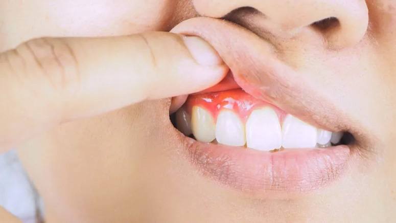 How to Identify and Treat a Cut on the Gums – Page 5 – Entirely Health