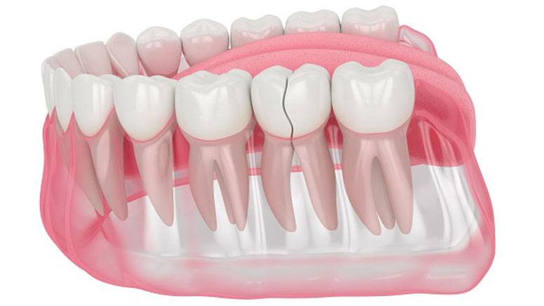 7 Possible Reasons Why Your Tooth Hurts When Biting Down – Page 4 ...