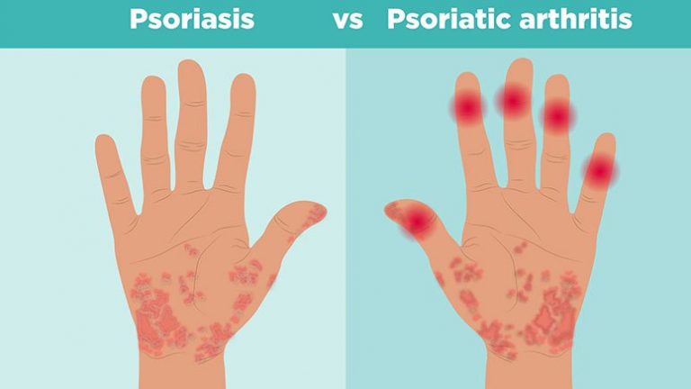 Tips to Relieve Foot Pain from Psoriatic Arthritis – Entirely Health