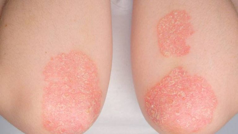Psoriasis in Kids (Pediatric Psoriasis) – Page 3 – Entirely Health