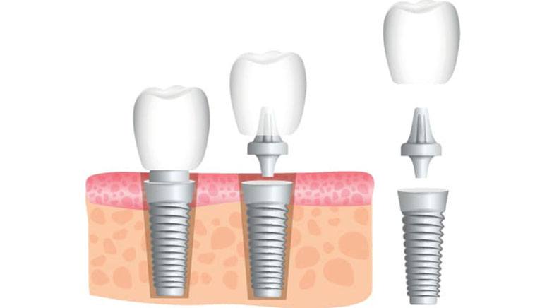 Titanium Dental Implants – What You Need to Know – Page 5 – Entirely Health