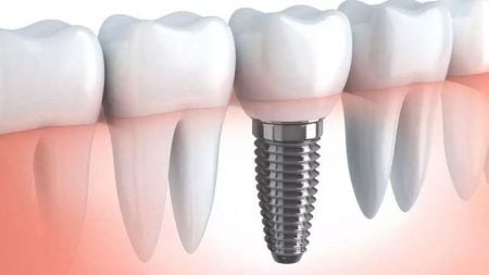Titanium Dental Implants – What You Need to Know – Entirely Health