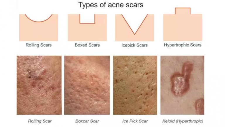 Pitted Acne Scars – Causes and Treatment Options – Page 3 – Entirely Health