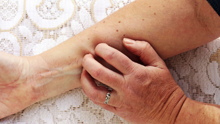 What Do Chigger Bites Look Like? – Page 5 – Entirely Health