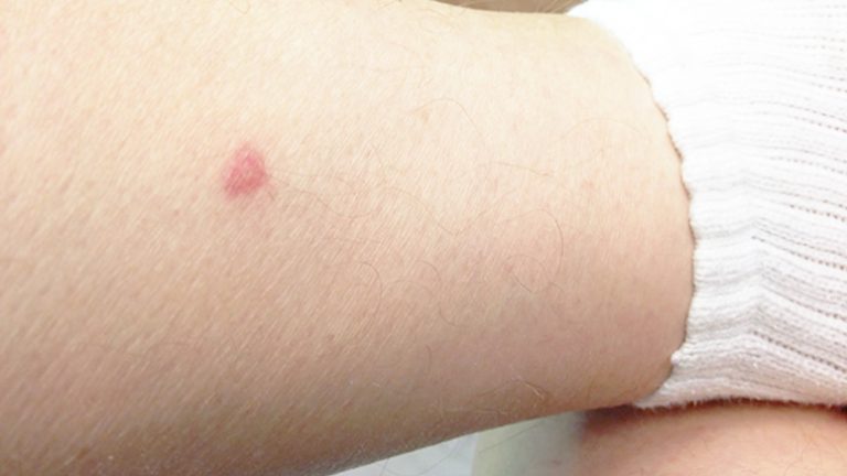 What Do Chigger Bites Look Like? – Page 3 – Entirely Health