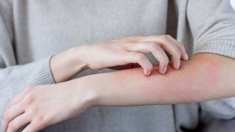 Atopic Vs Contact Dermatitis: What’s The Difference? – Page 3 ...