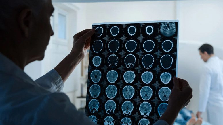Dopamine and Parkinson Disease- What to Know – Page 6 – Entirely Health