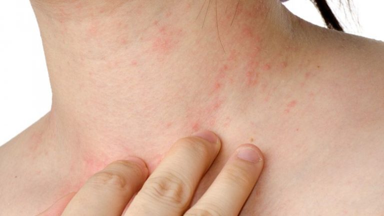 Atopic Vs Contact Dermatitis: What’s The Difference? – Entirely Health
