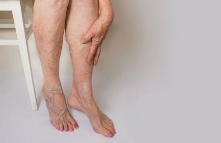 Varicose Vein Stripping (Phlebectomy) – Entirely Health