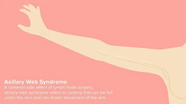 Axillary Web Syndrome – Symptoms, Causes, and Treatments – Entirely Health