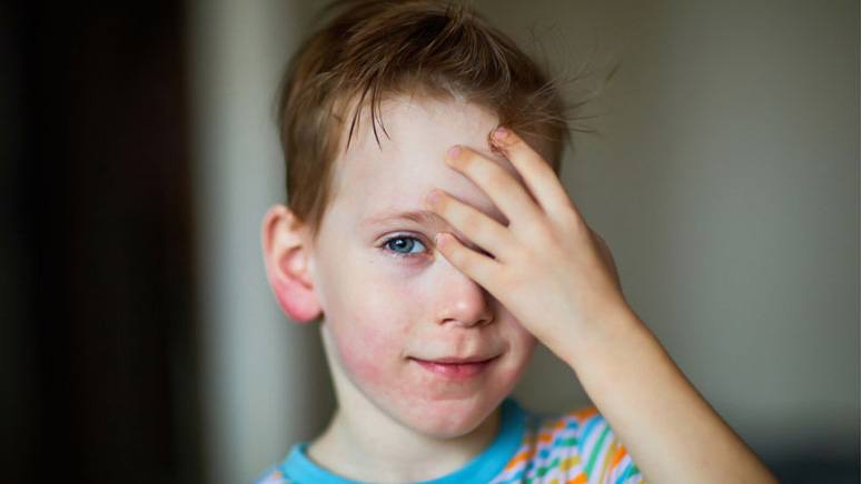 Eczema vs. Hives: What Is the Difference? – Entirely Health