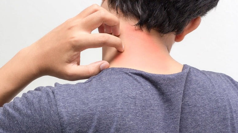 Eczema vs. Hives: What Is the Difference? – Page 8 – Entirely Health