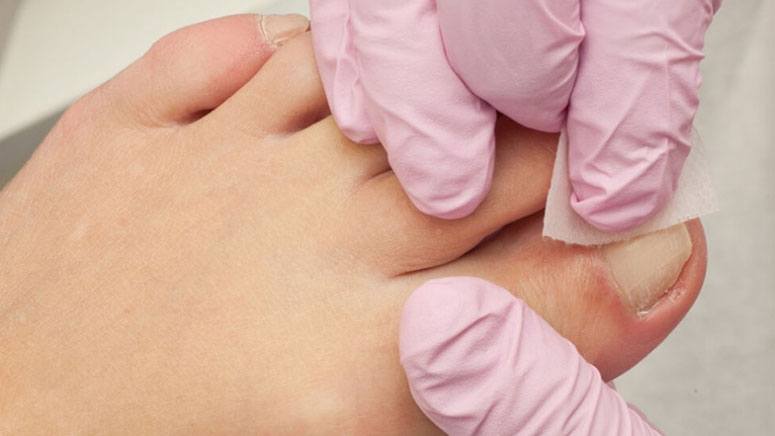 Fingernail and Toenail Pain – Symptoms, Causes and Treatments – Page 10 ...