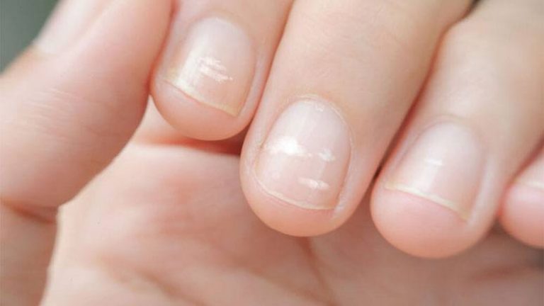 Fingernail and Toenail Pain – Symptoms, Causes and Treatments – Page 7 ...