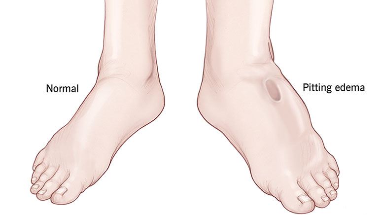 Edema: Symptoms, Causes and Treatments – Page 4 – Entirely Health
