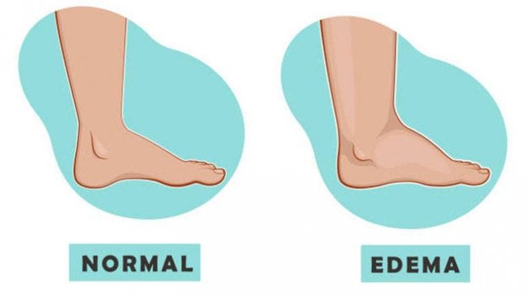 Edema: Symptoms, Causes and Treatments – Page 2 – Entirely Health