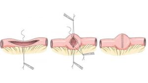 Strictureplasty Surgery: What You Need to Know – Entirely Health