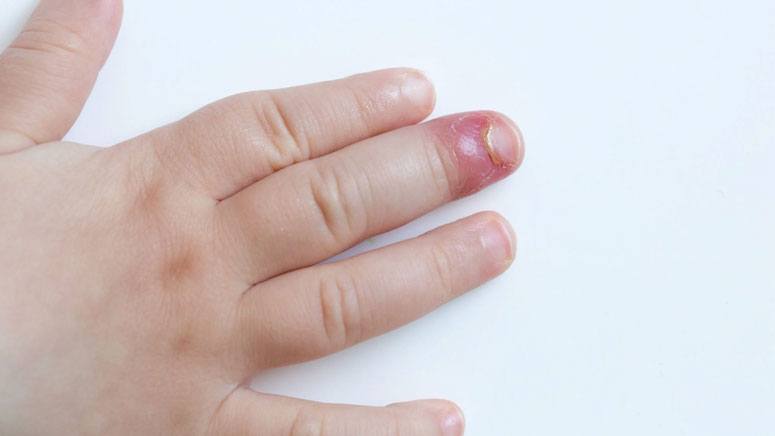 Fingernail and Toenail Pain – Symptoms, Causes and Treatments – Page 8 ...