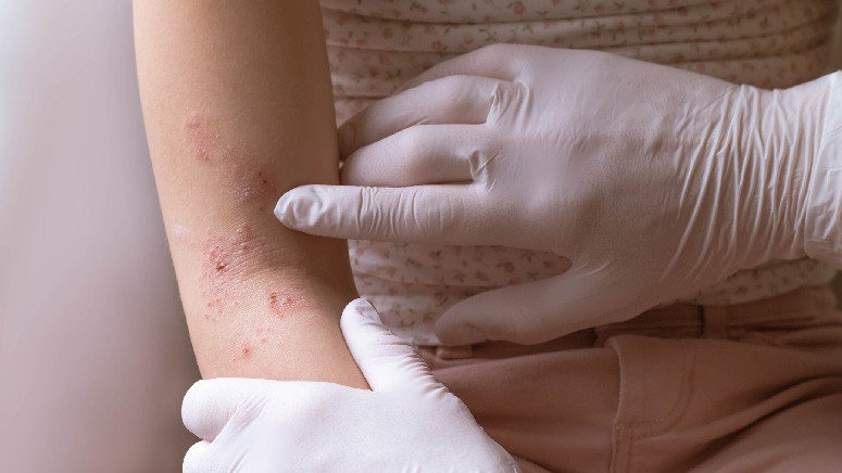 Eczema and Inflammation- Everything You Need to Know – Entirely Health