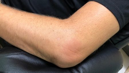 Enthesopathy – Symptoms, Treatments & More – Entirely Health