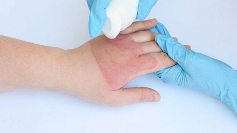 Ice Burn: Symptoms, Treatment, and More – Page 2 – Entirely Health