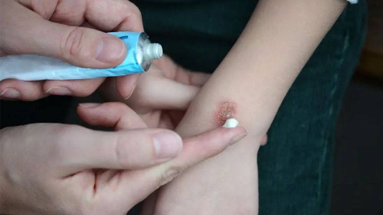 Ice Burn: Symptoms, Treatment, and More – Page 6 – Entirely Health