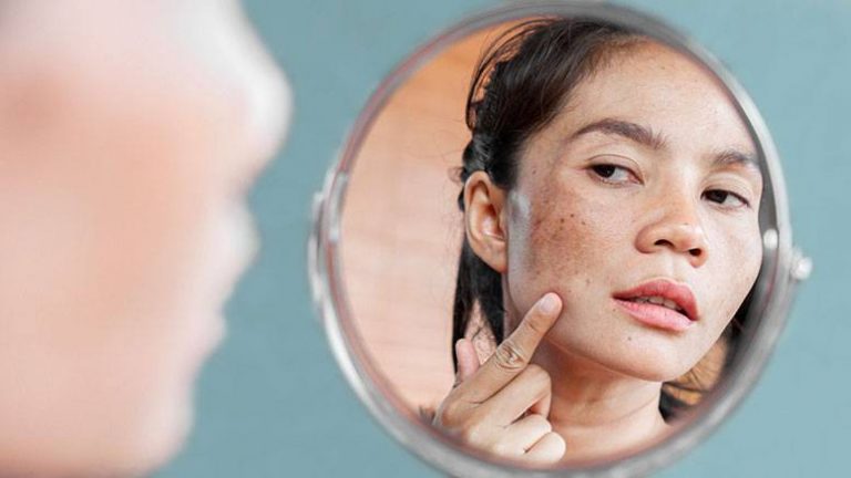 Hyperpigmentation on Buttocks: Causes, Treatments and More – Entirely ...