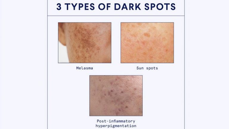 Hyperpigmentation on Buttocks: Causes, Treatments and More – Page 2 ...