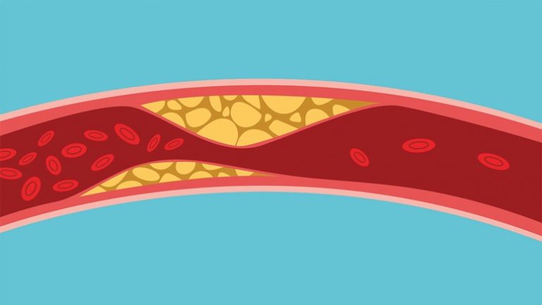 How Triglycerides Affect Your Health? – Entirely Health