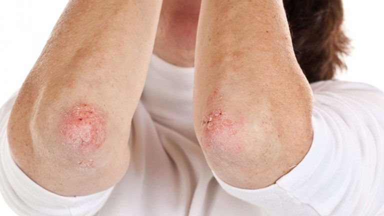 Koebner Phenomenon: An Overview – Entirely Health