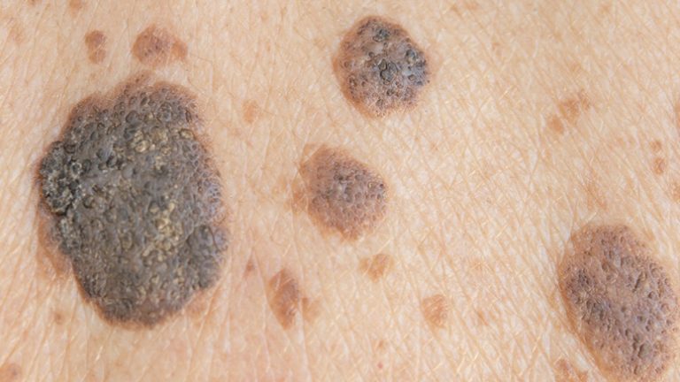 Should I Worry About a Crusty Mole? – Page 7 – Entirely Health