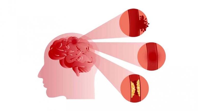 Essential Tremor: Symptoms, Causes, Diagnosis, and Treatments – Page 3 ...