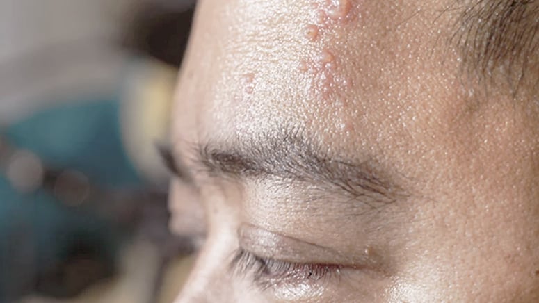 How Dangerous Are Shingles in the Elderly? – Entirely Health