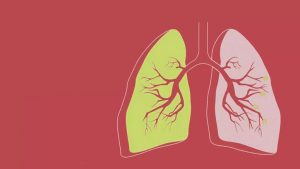 Is Emphysema a Risk Factor for Lung Cancer? – Entirely Health