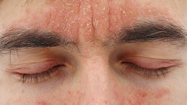 Eczema and Hard Water – What’s the Connection? – Page 5 – Entirely Health