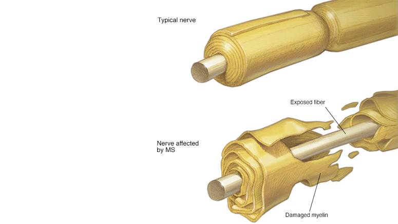 Ms Tingling Patterns – What To Know And How To Cope – Entirely Health