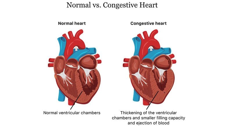 Congestive Heart Failure Life Expectancy – Page 4 – Entirely Health