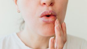 Mosquito Bite on Lips: Treatments & Prevention – Entirely Health