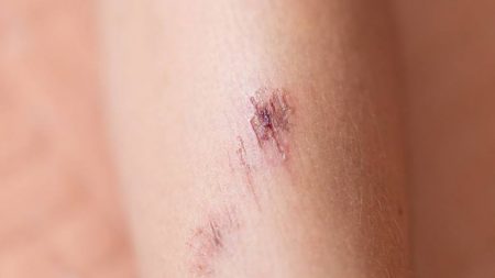 What to Do About a Scab on Your Lips – Entirely Health